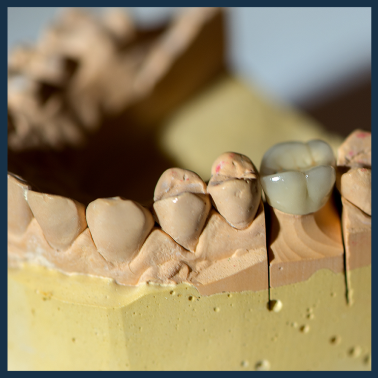 Locator male processing package standard, 2-pack - Overdenture ...