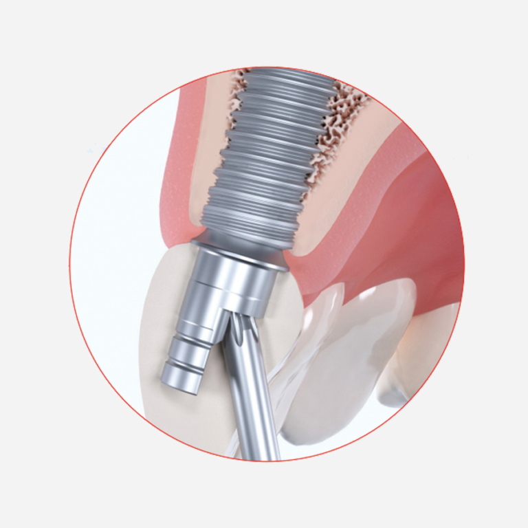 Placement Instrument Novaloc Abutment, Angled, ASC flex Ti-base ...
