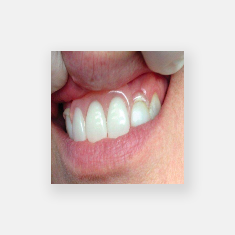 Itsoclear clasps - Keystone - Abutment Direct