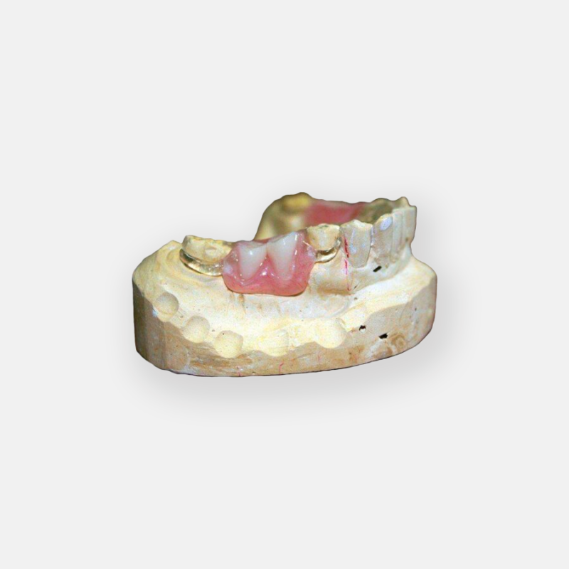 Itsoclear clasps - Keystone - Abutment Direct